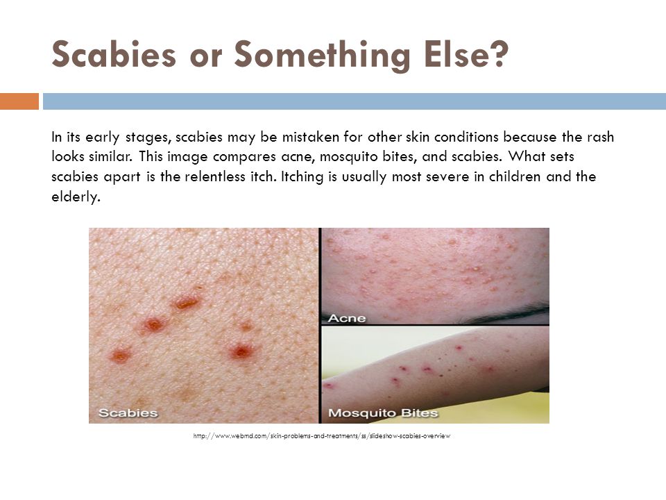 Early Scabies Rash