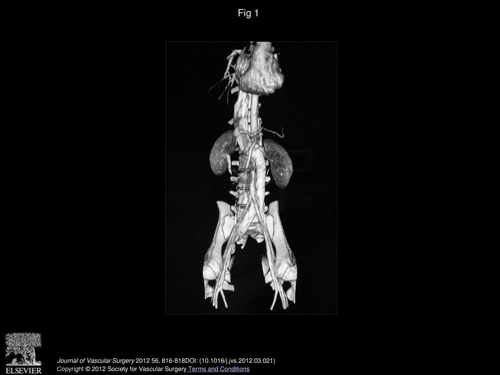 Nutcracker Syndrome Due To Left Sided Inferior Vena Cava Compression