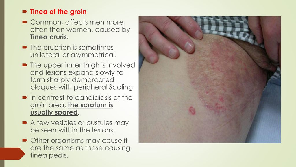 Tinea Cruris Scrotum