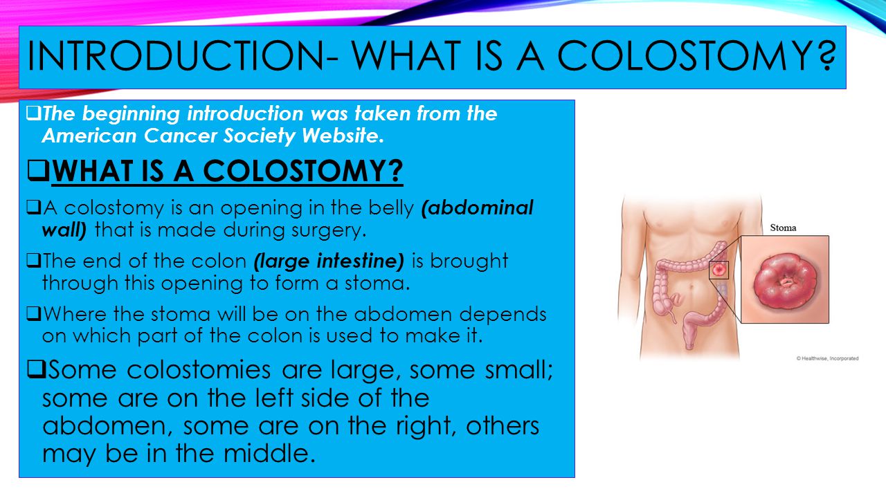Sigmoid Colostomy Irrigation