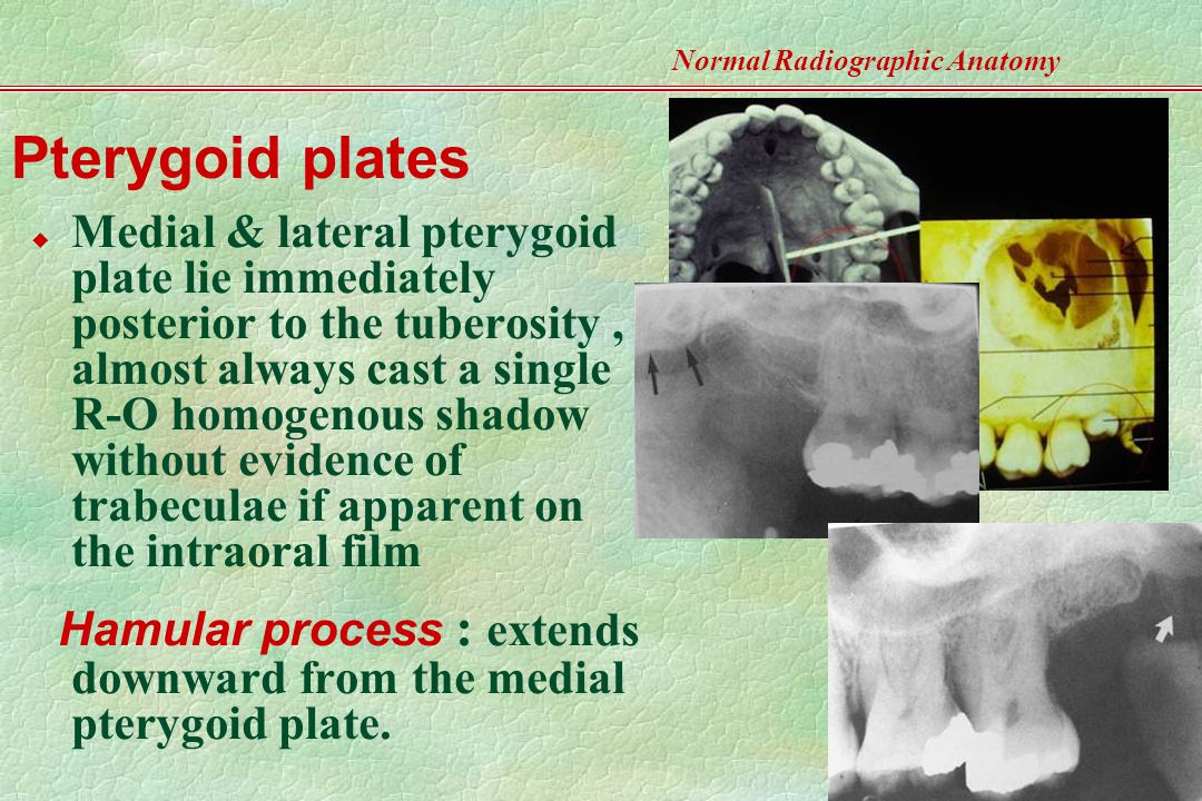 Pterygoid Plate Radiograph