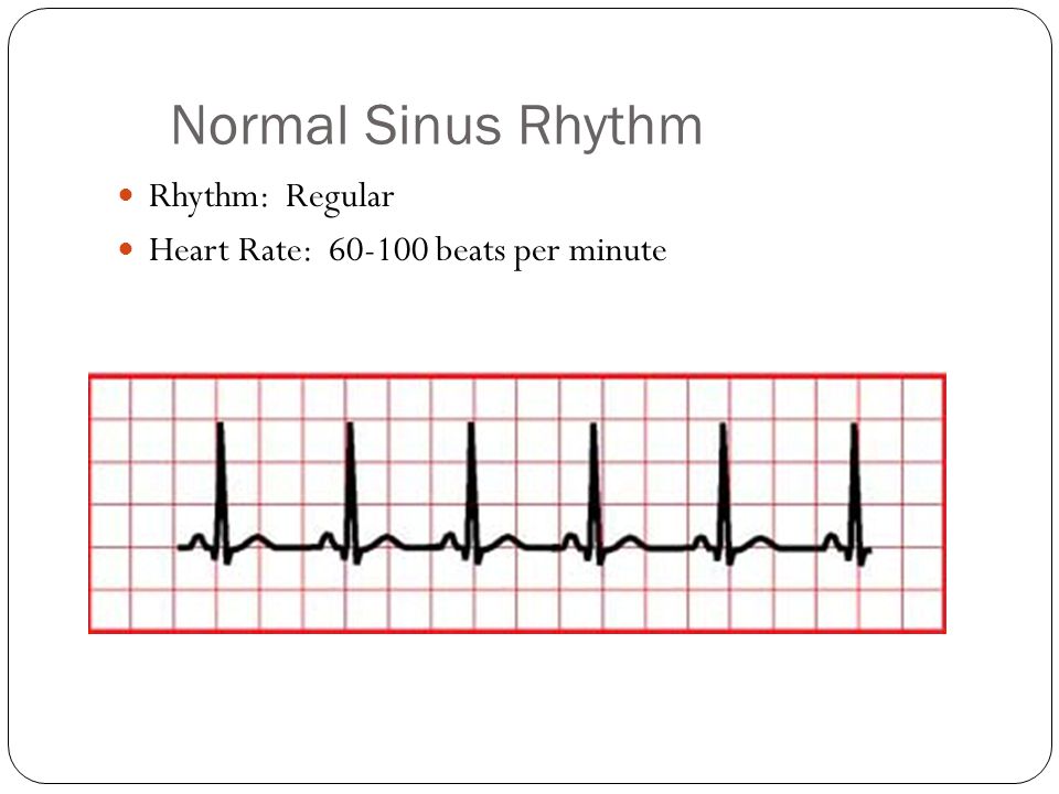 ECG Interpretation Cheat Sheet WHAT EXACTLY IS AN ECG? An, 41% OFF ECG Interpretation Cheat Sheet WHAT EXACTLY IS AN ECG? An, 41% OFF