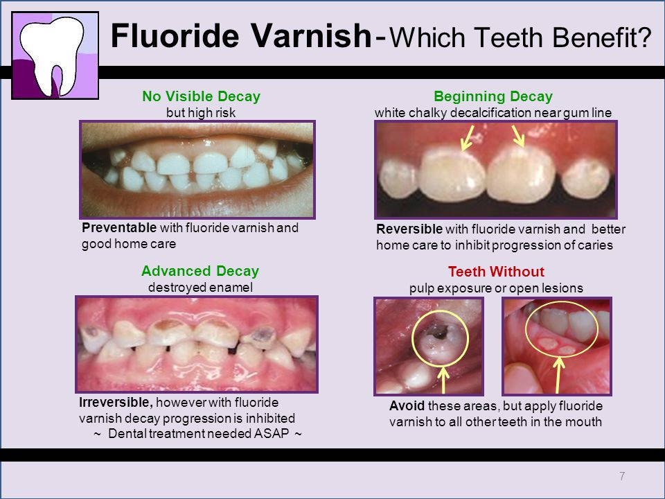Fluoride Varnish For Kids Fluoride Varnish For Kids