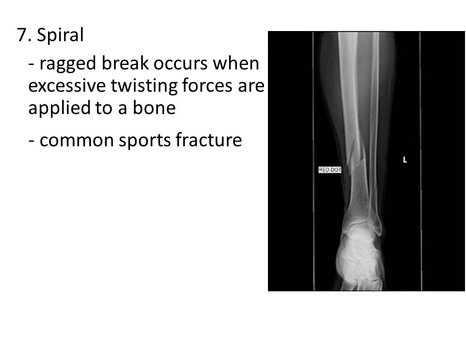 Salter-Harris Fracture Classification System Mnemonic: Type, 52% OFF Salter-Harris Fracture Classification System Mnemonic: Type, 52% OFF