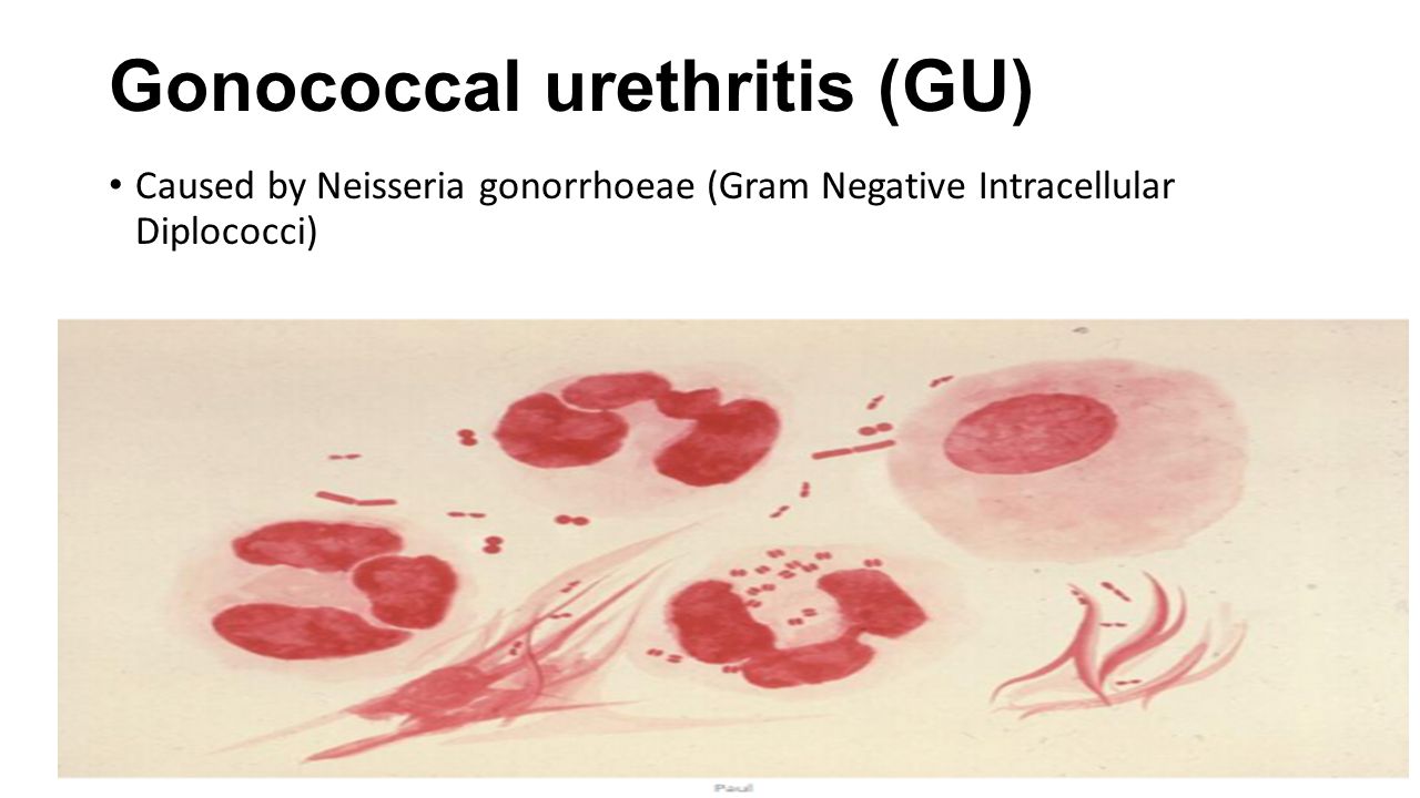 Urethritis And Genital Discharge Ppt Video Online Download